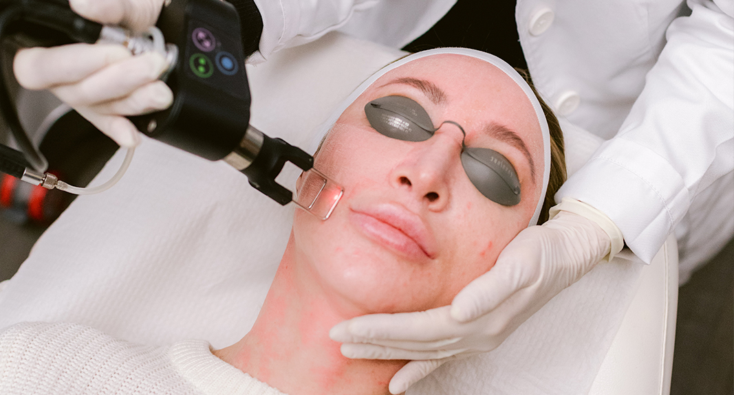 SmartSkin® CO2 Laser Skin Resurfacing Treatment