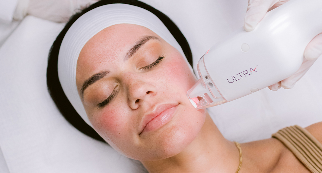 Lutronic Ultra Laser Resurfacing - The Skin Center